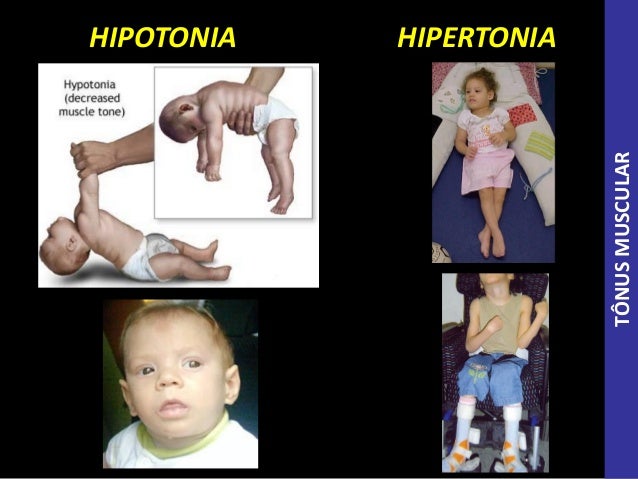 Tônus Muscular