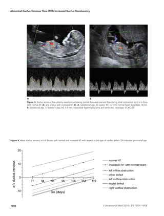Abnormal Ductus Venosus Flow With Increased Nuchal Translucency | PDF