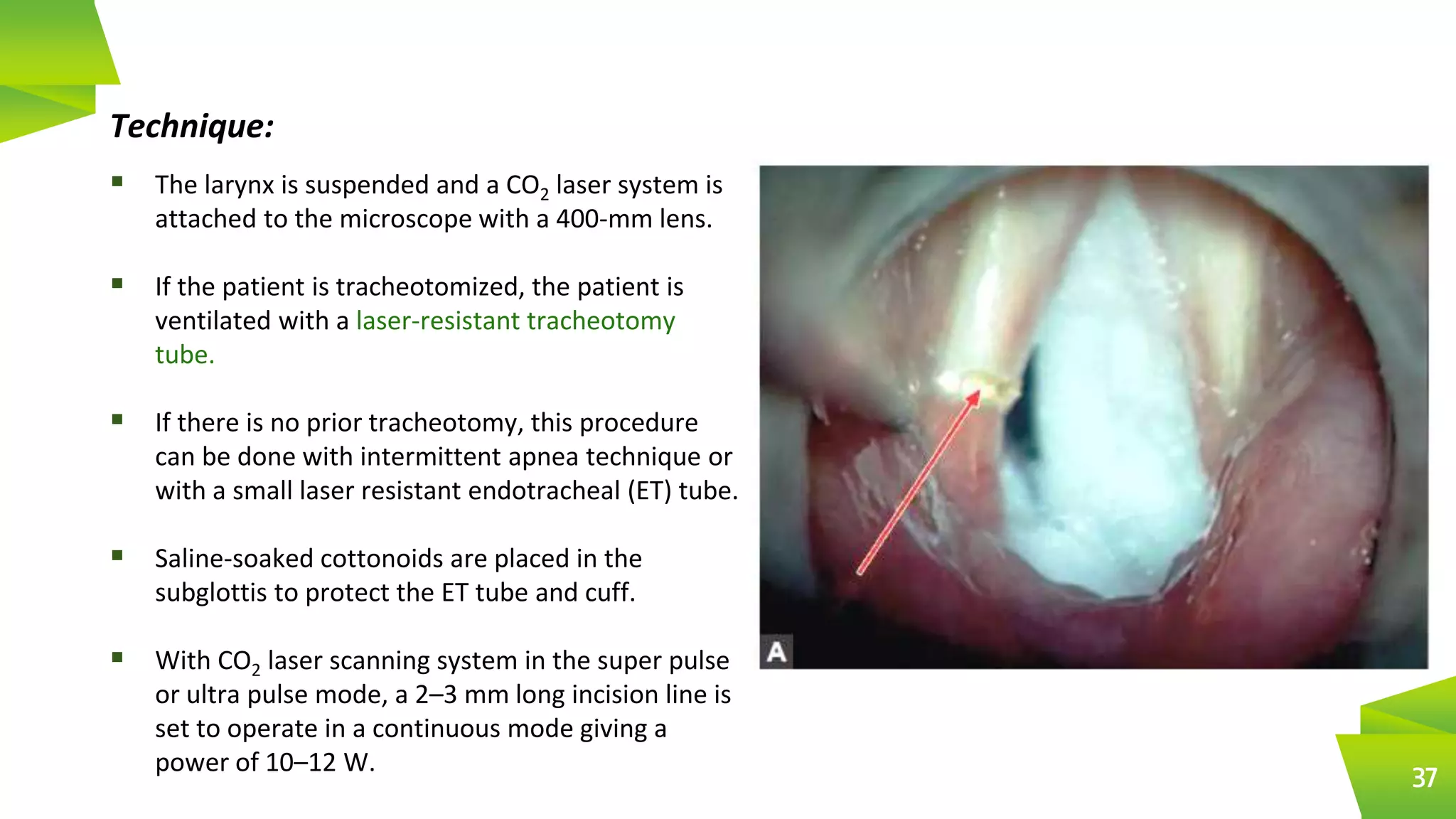 Vocal cord palsy management | PPTX