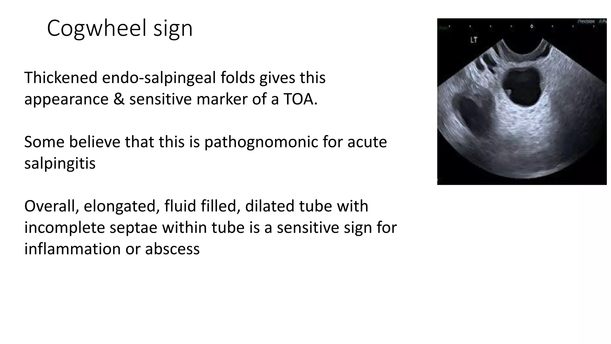 TUBO OVARIAN ABSCESS | PPTX