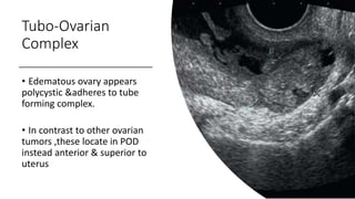 TUBO OVARIAN ABSCESS | PPTX