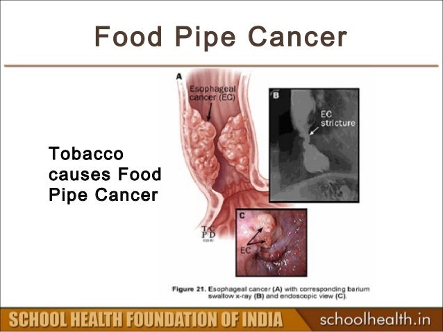 Ulcers From Smoking
