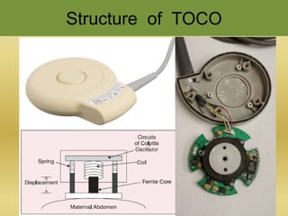 Tocodynamometer, cardiotocogram | PPT
