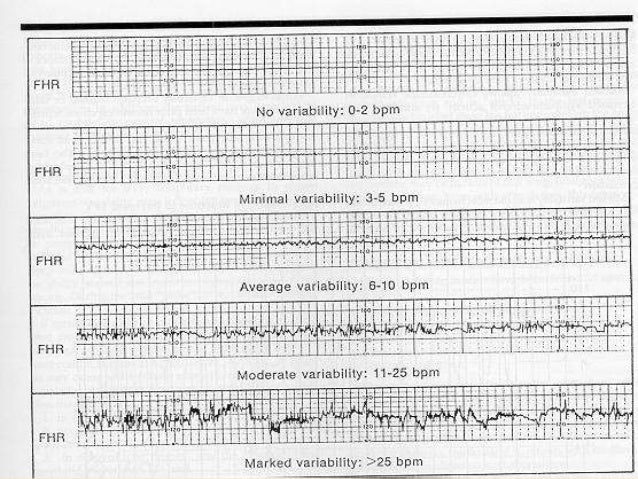 Tocodynamometer, cardiotocogram