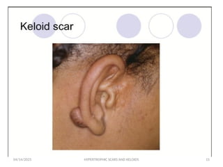 Hypertrophic scars and keloids............ | PPTX
