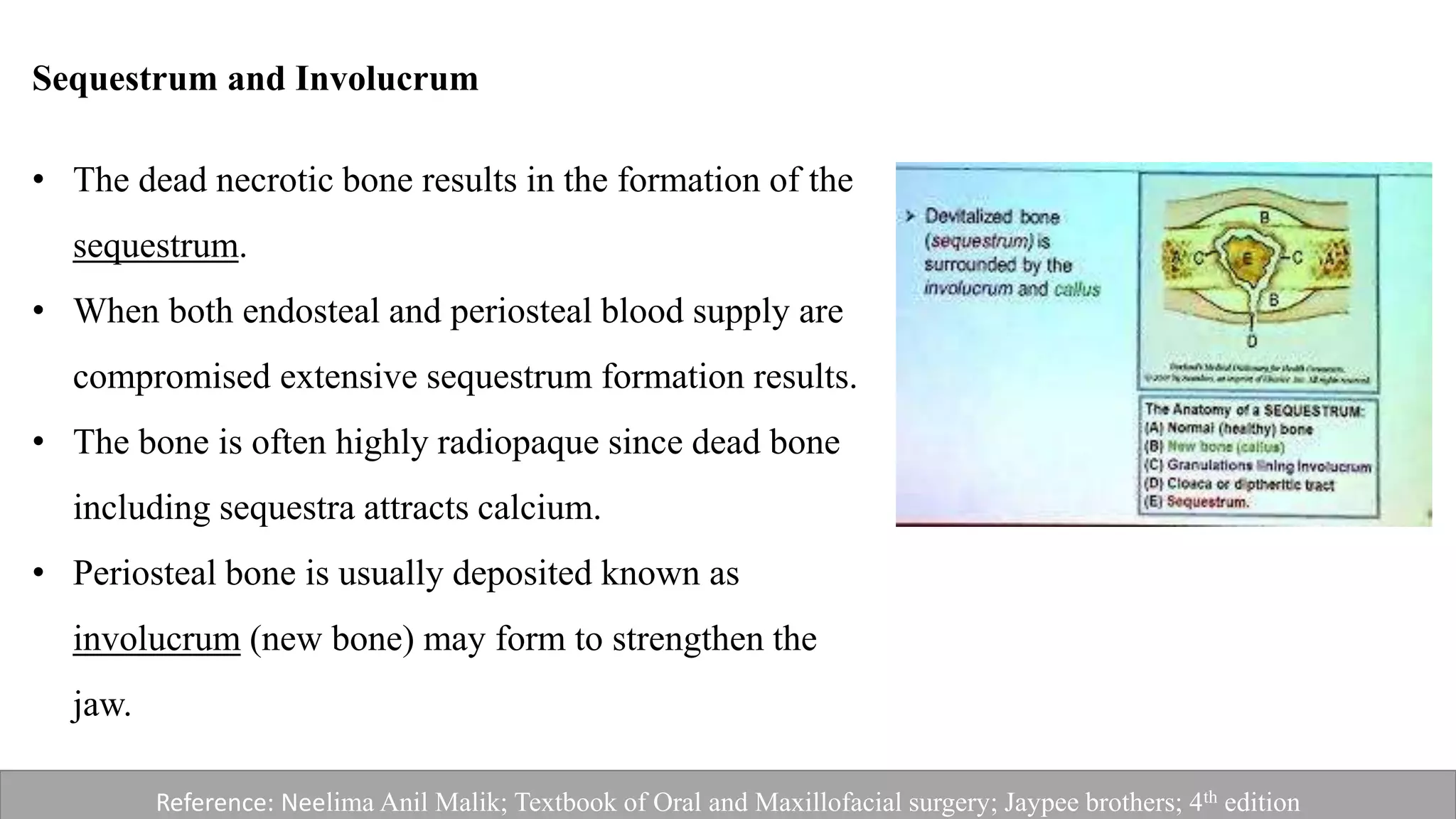 Osteomyelitis of jaw | PPTX