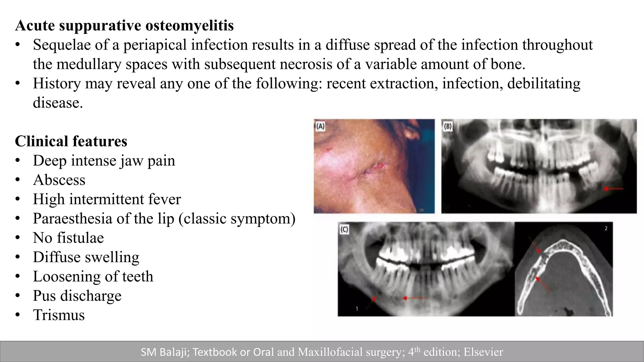 Osteomyelitis of jaw | PPTX