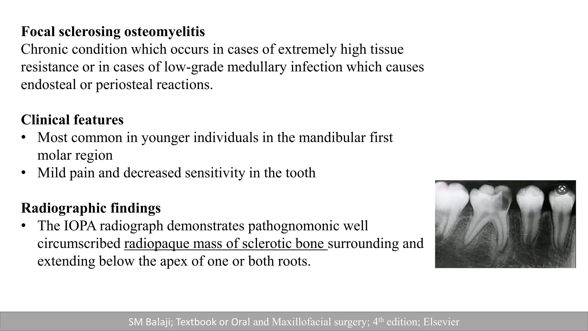 Osteomyelitis of jaw | PPTX