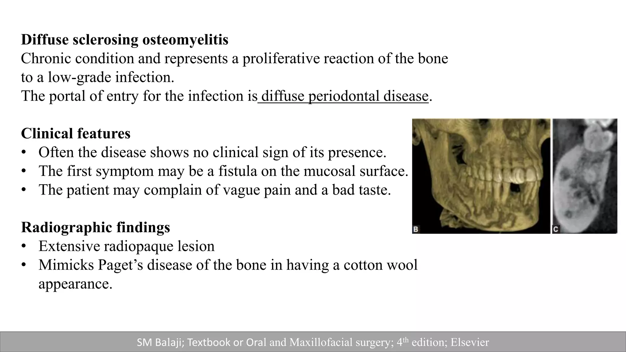 Osteomyelitis of jaw | PPTX