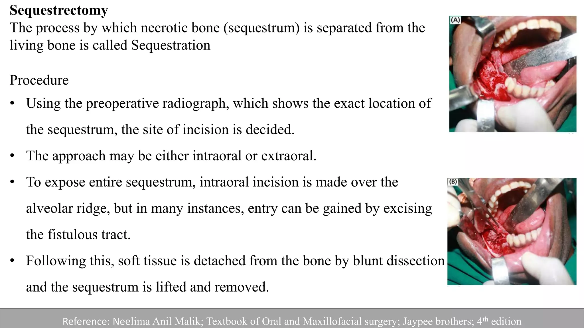 Osteomyelitis of jaw | PPTX