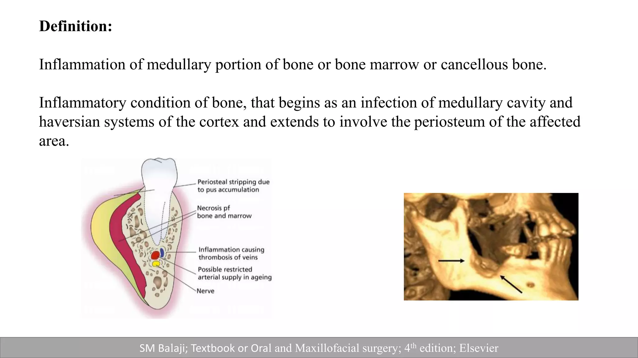 Osteomyelitis of jaw | PPTX
