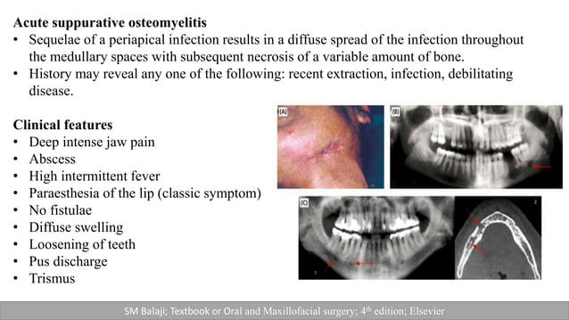 Osteomyelitis of jaw | PPTX | Bone and Joint Conditions | Diseases and ...