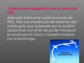 ulcera peptica y gastritis | PPT
