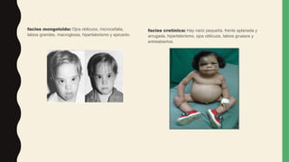Todos los tipos de Facies y sus patologías | PPTX
