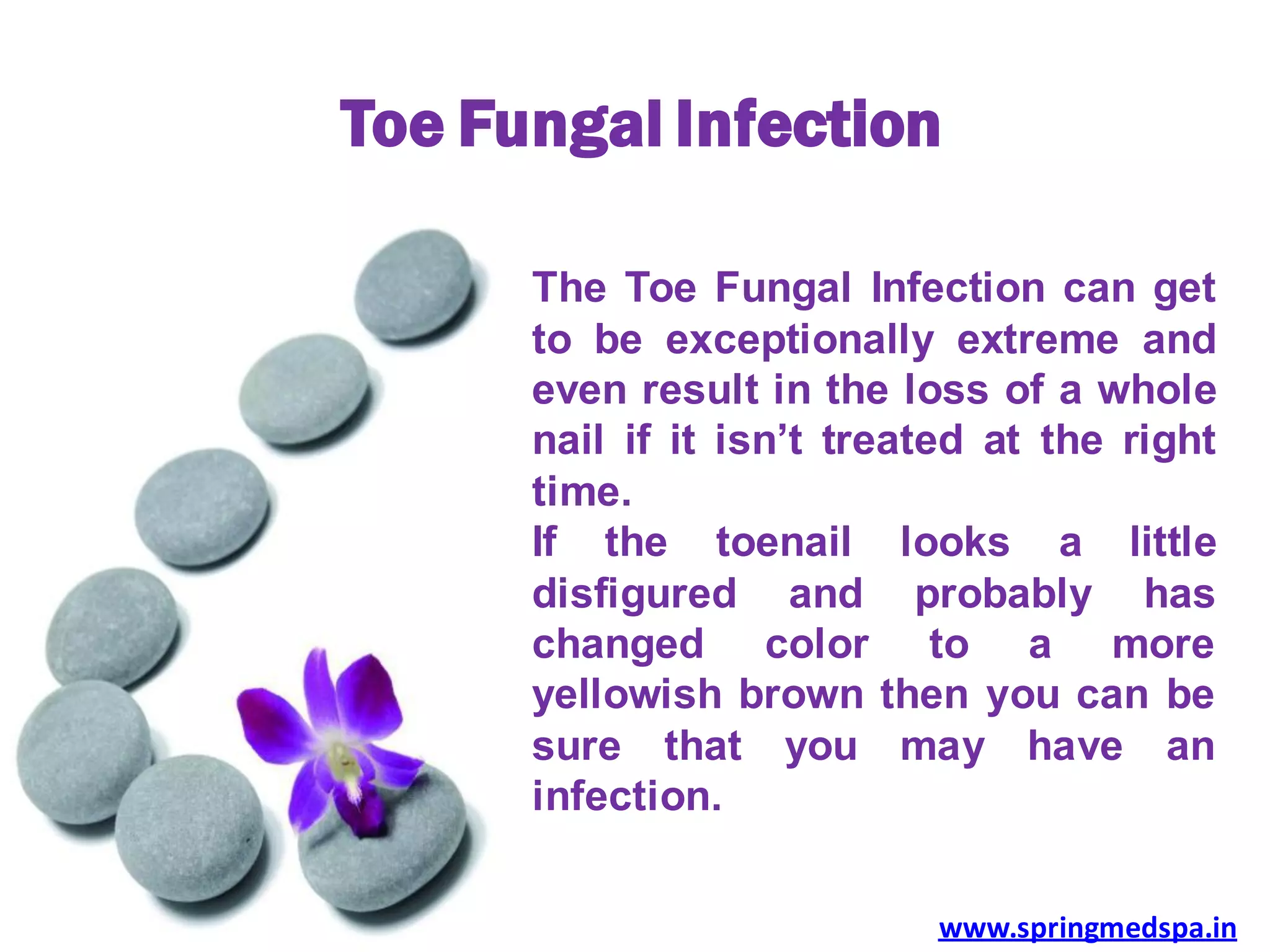Toe Nail Fungal Infections & Treatments | PDF