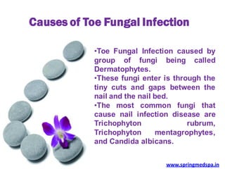 Toe Nail Fungal Infections & Treatments | PDF