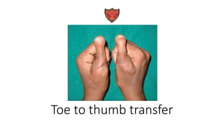 TOE to THUMB transfer ppt.pptx