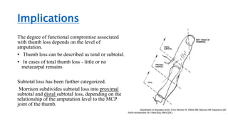 TOE to THUMB transfer ppt.pptx