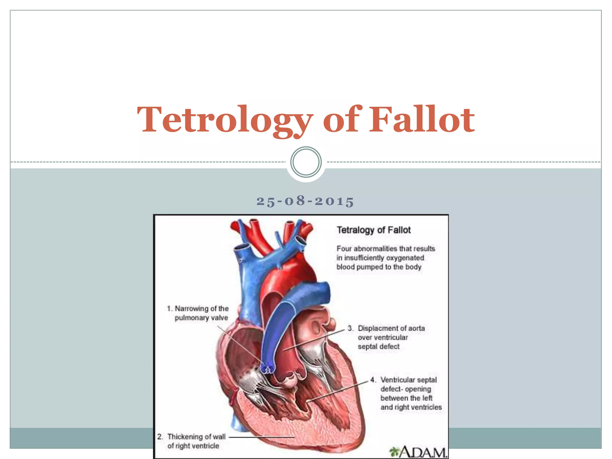 Tetrology of Fallot (TOF) - A Review | PPTX