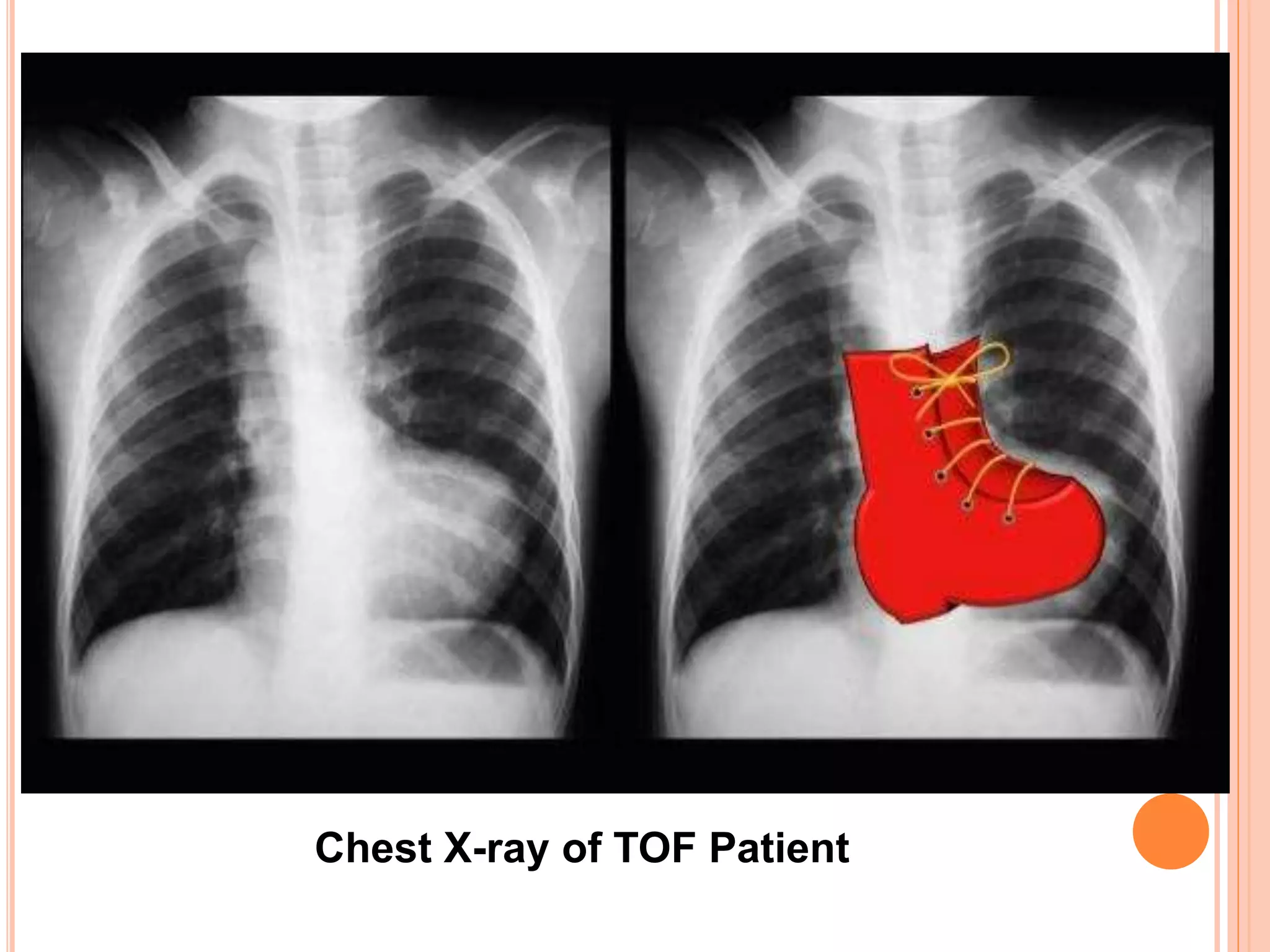Tetralogy of Fallot (TOF) | PPTX