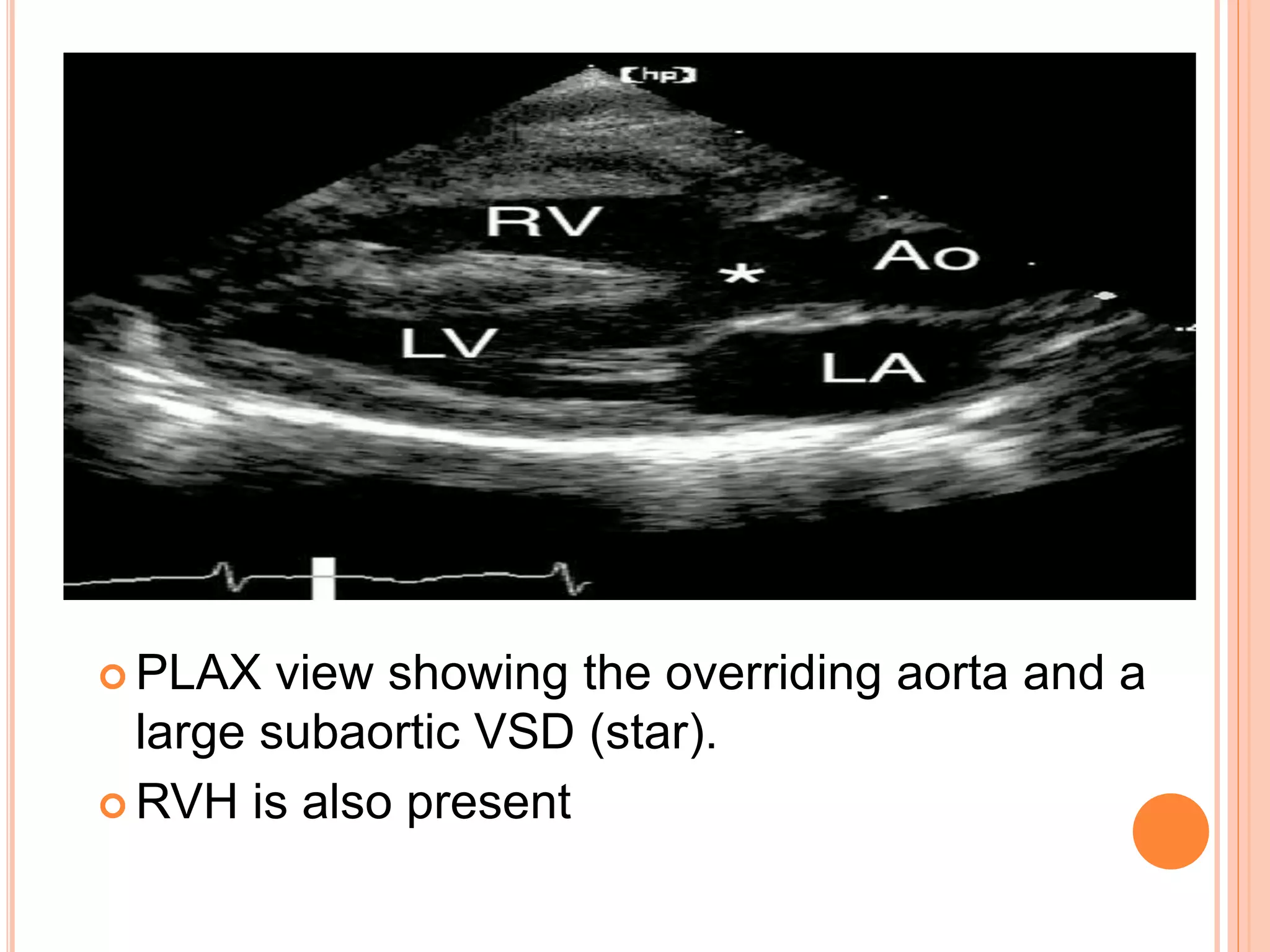 Tetralogy of Fallot (TOF) | PPTX