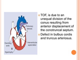 Tetralogy of Fallot (TOF) | PPTX