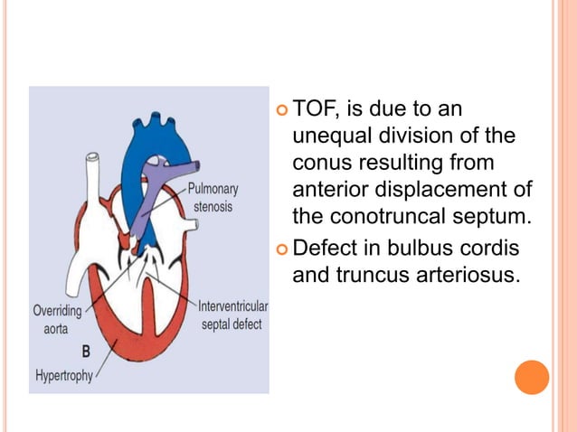 Tetralogy of Fallot (TOF) | PPTX