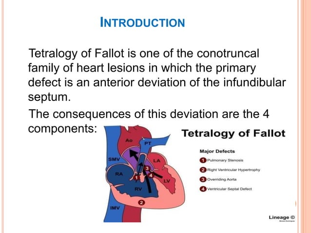Tetralogy of Fallot (TOF) | PPTX