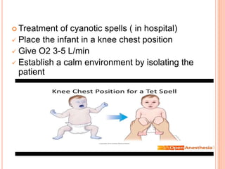 Knee Chest Position Tetralogy Fallot