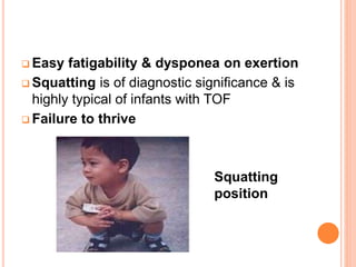 Tetralogy of Fallot (TOF) | PPT