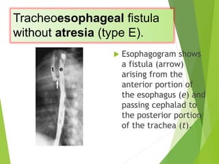 Tracheoesophageal Fistula Barium Swallow