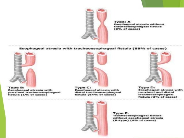 tracheo oesophagal fistula gihs