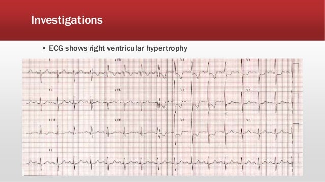 Tetralogy of fallot