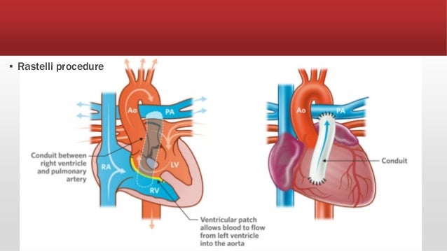 Tetralogy of fallot