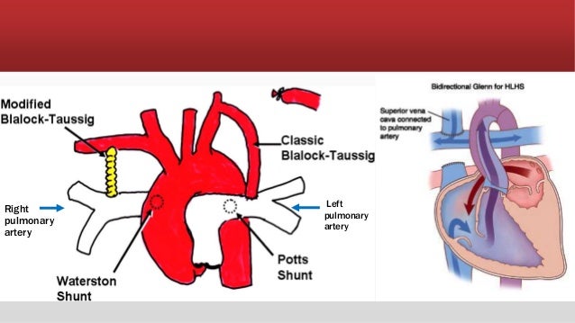 Tetralogy of fallot