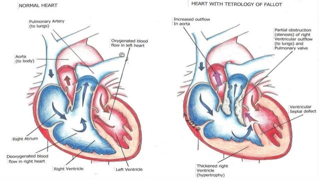Tetralogy of fallot