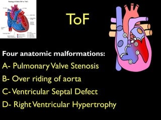 TOF, VSD in children | PPT