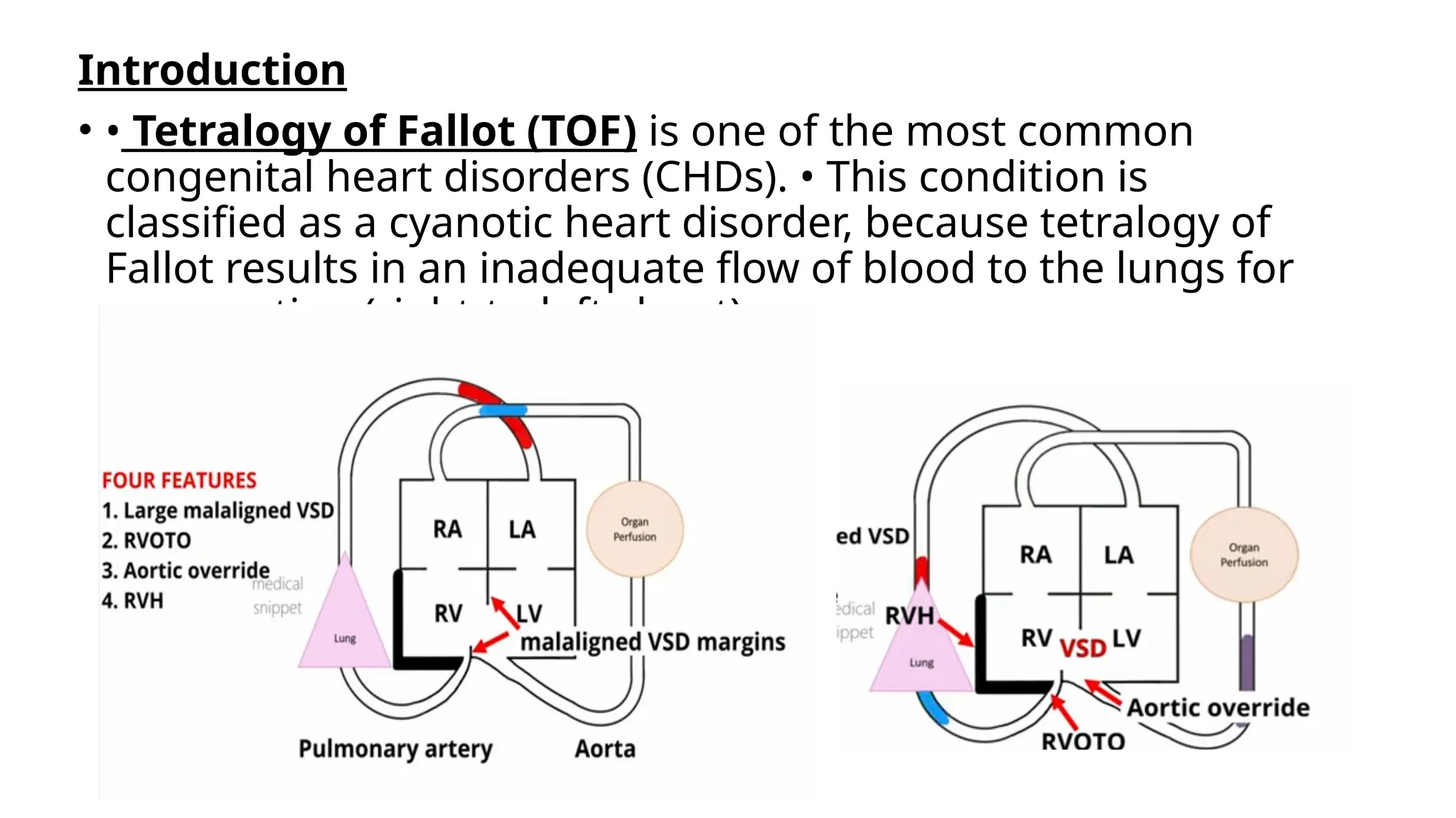 TOF BY DR POOJA anatomy tetralogy of fallot.pptx