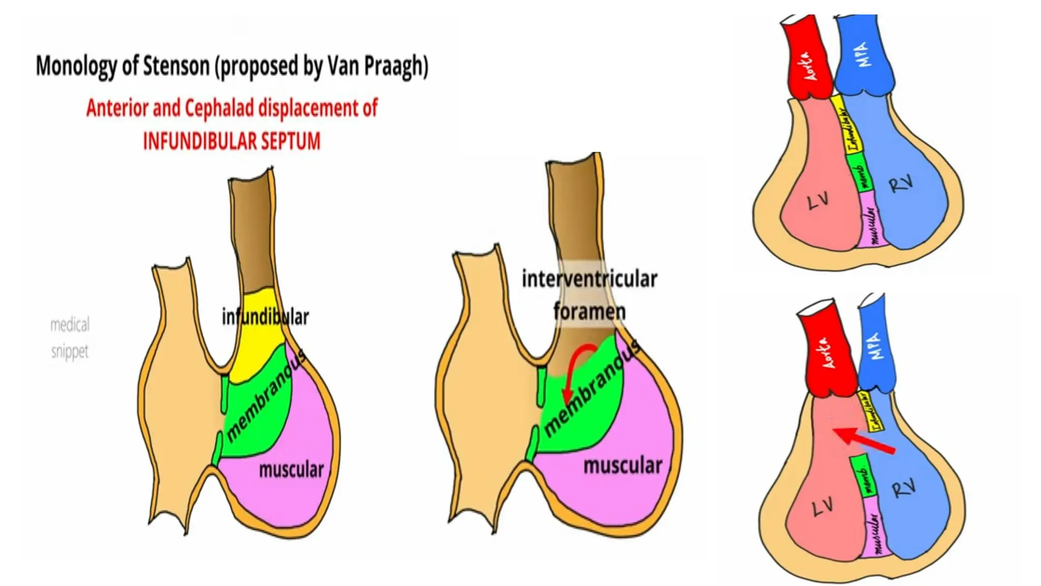 TOF BY DR POOJA anatomy tetralogy of fallot.pptx