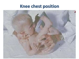 Knee Chest Position Child
