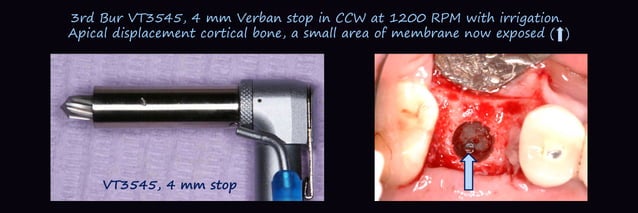 Toffler densah lift | PPTX