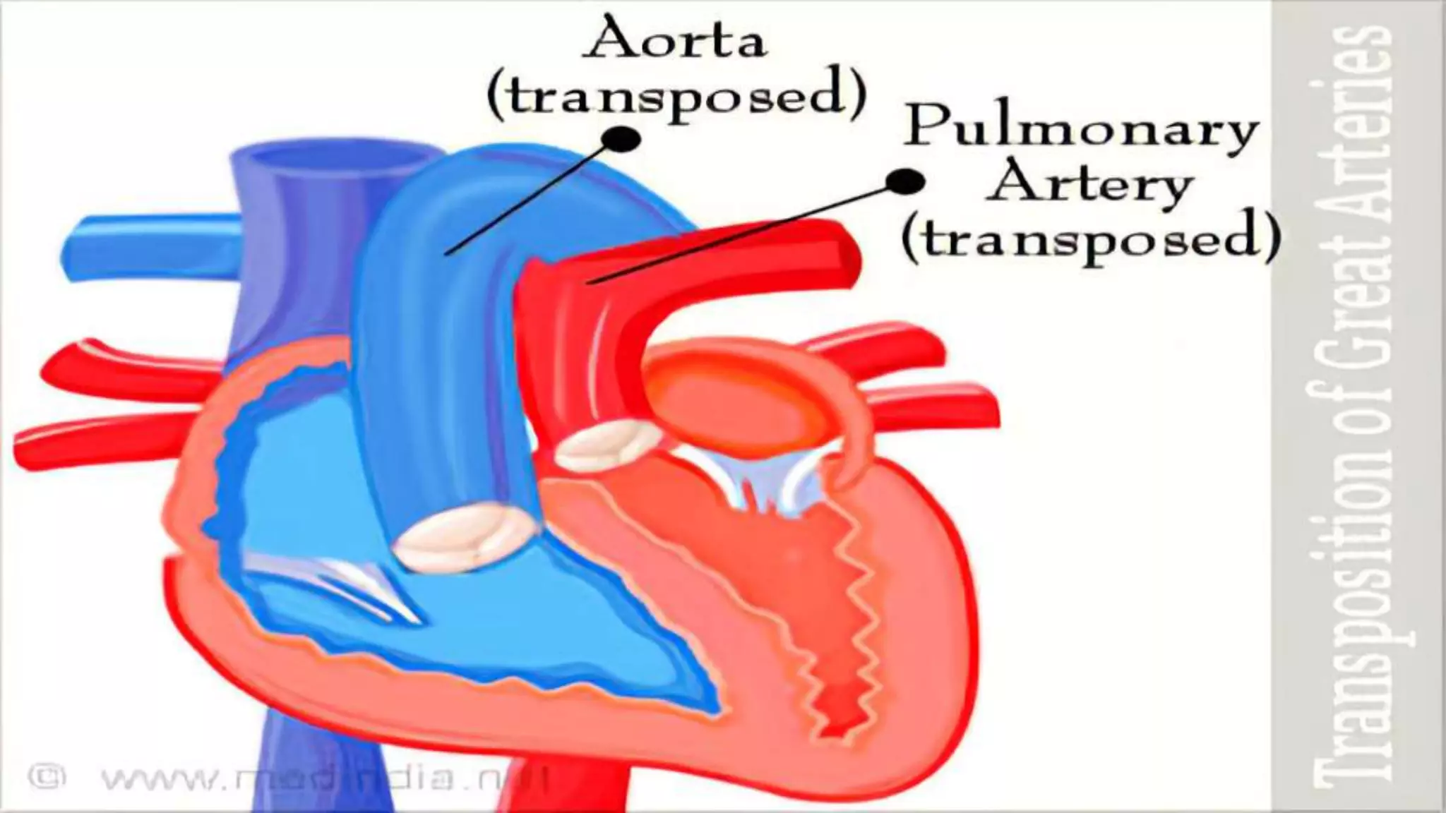 TOA (TRANSPOSION OF GREAT ARTERIES) | PPTX