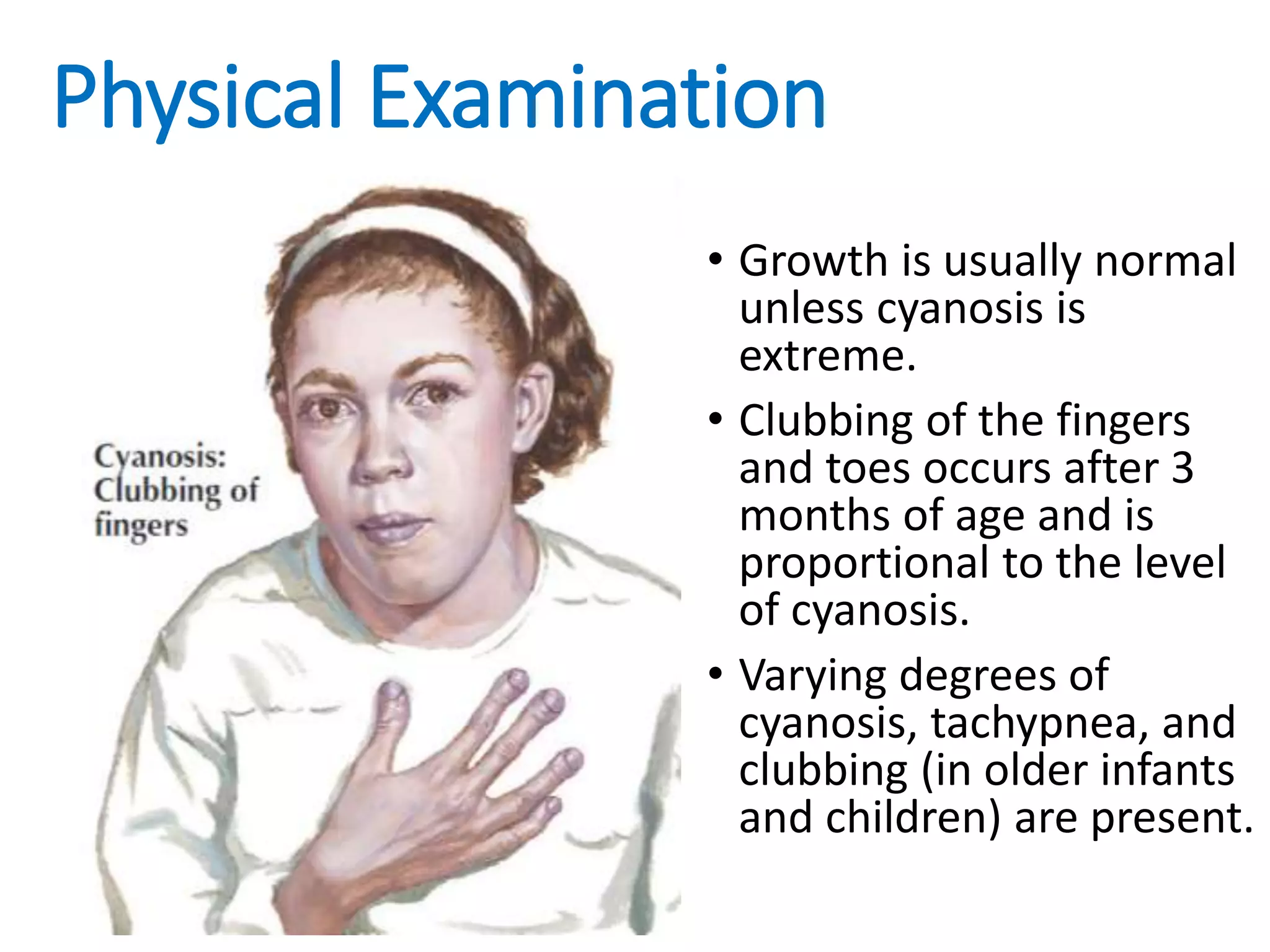 Tetralogy of Fallot (TOF) | PPTX