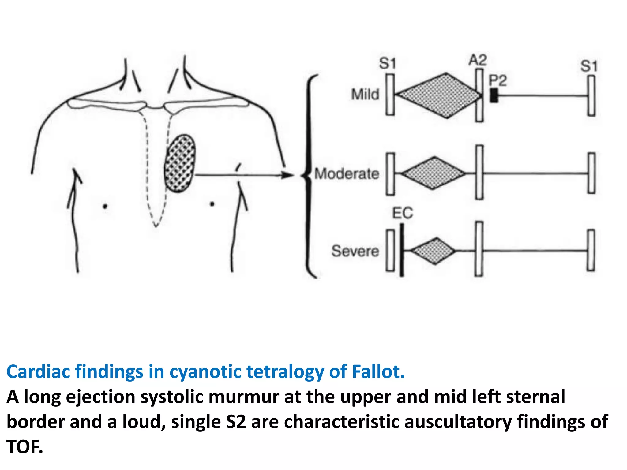Tetralogy of Fallot (TOF) | PPTX