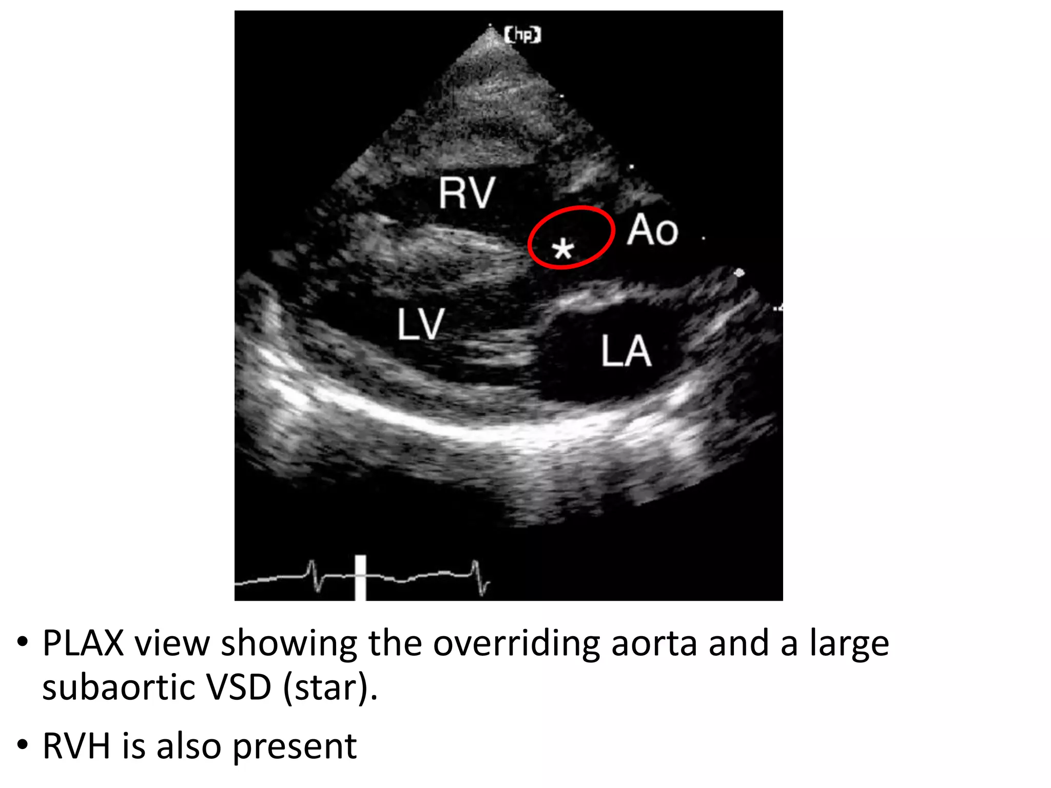 Tetralogy of Fallot (TOF) | PPTX