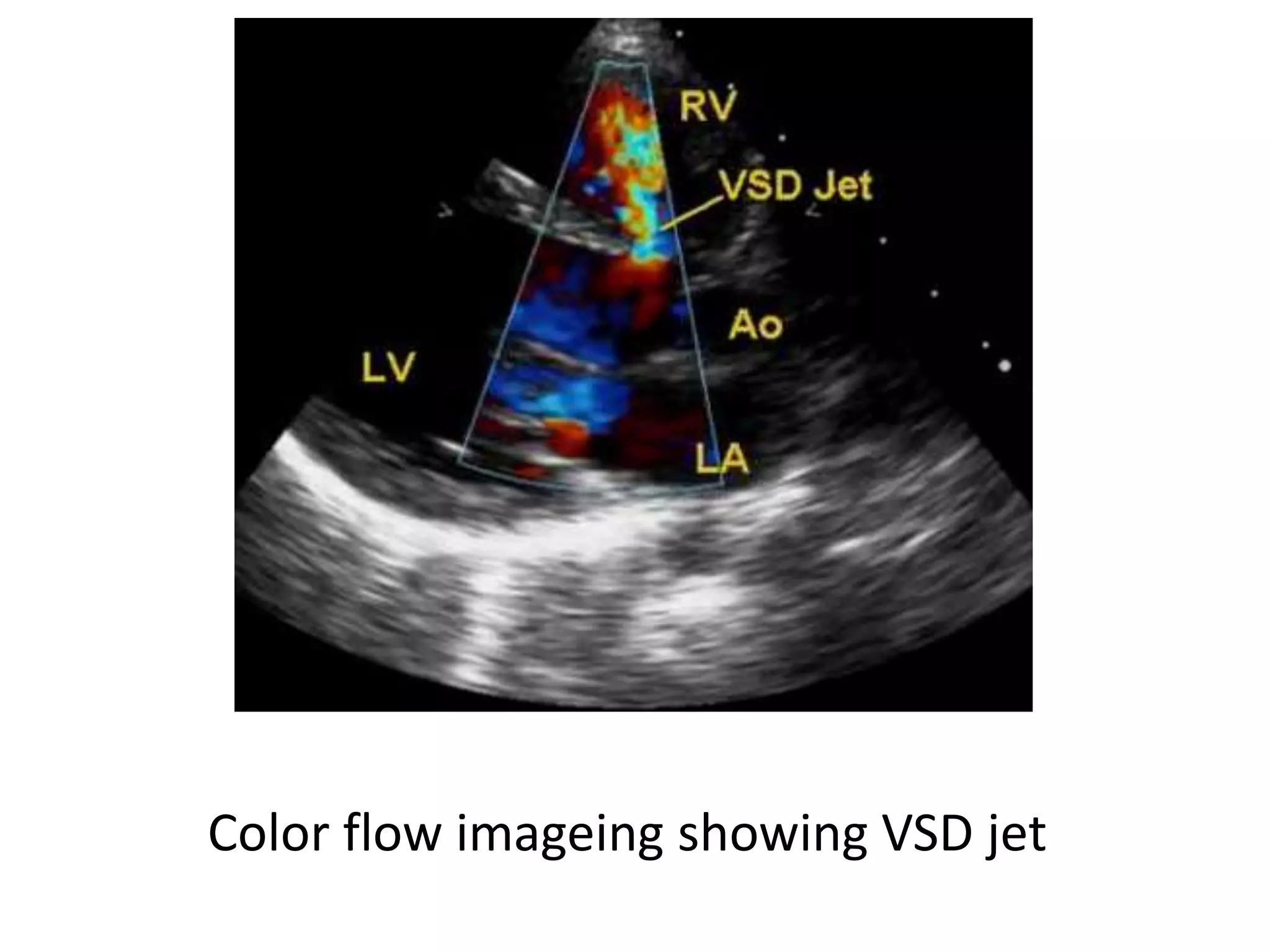 Tetralogy of Fallot (TOF) | PPTX