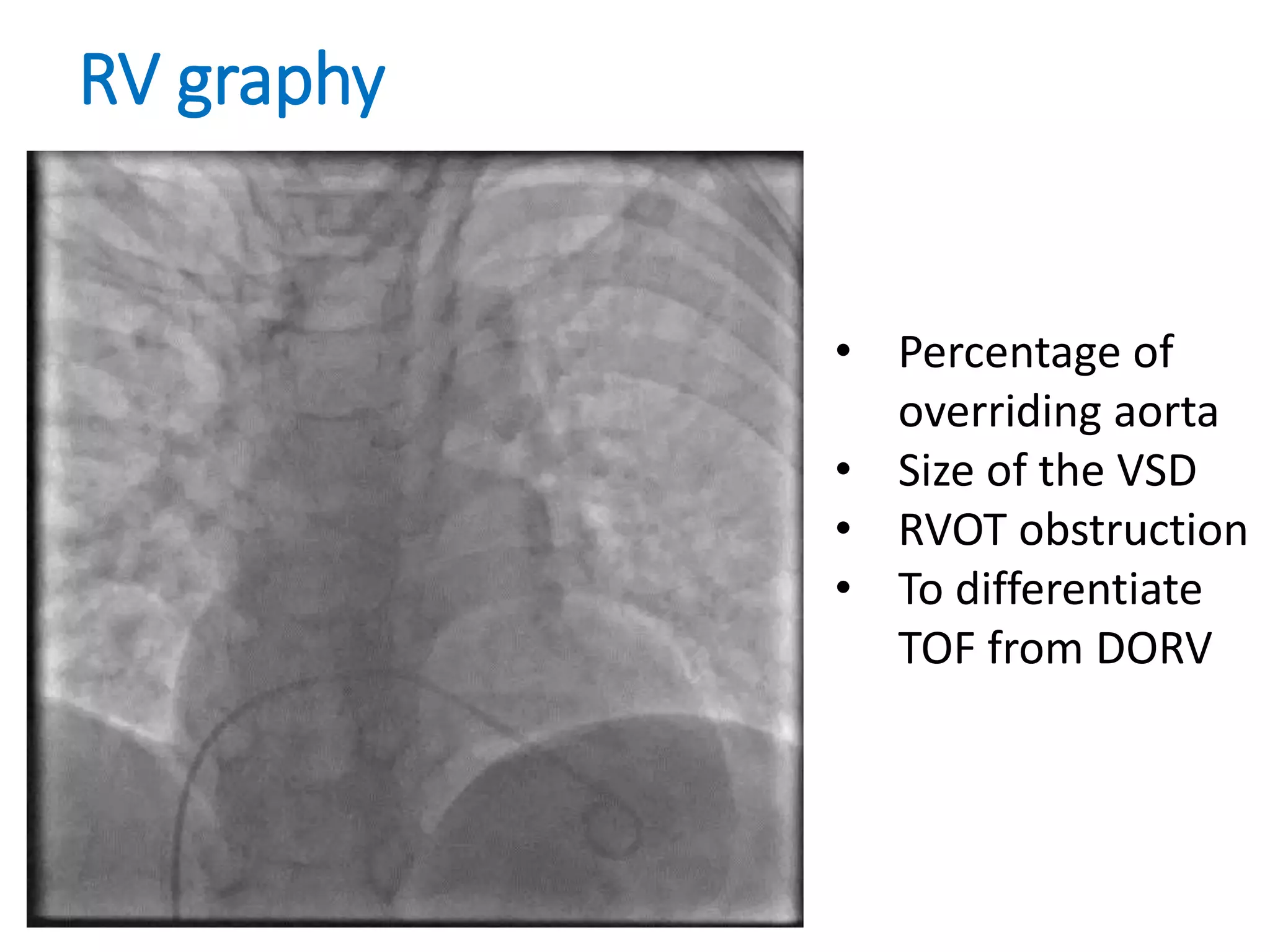 Tetralogy of Fallot (TOF) | PPTX