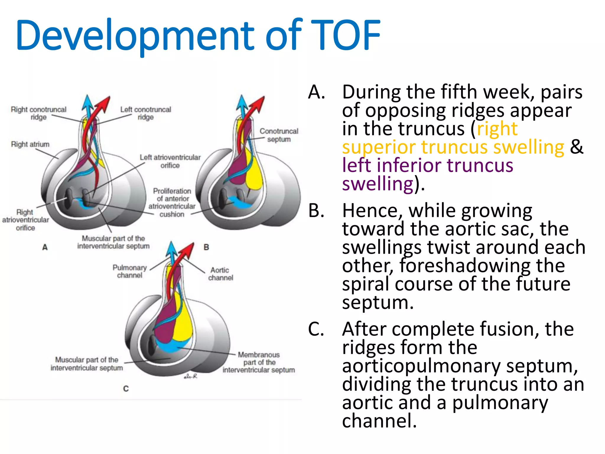 Tetralogy of Fallot (TOF) | PPTX