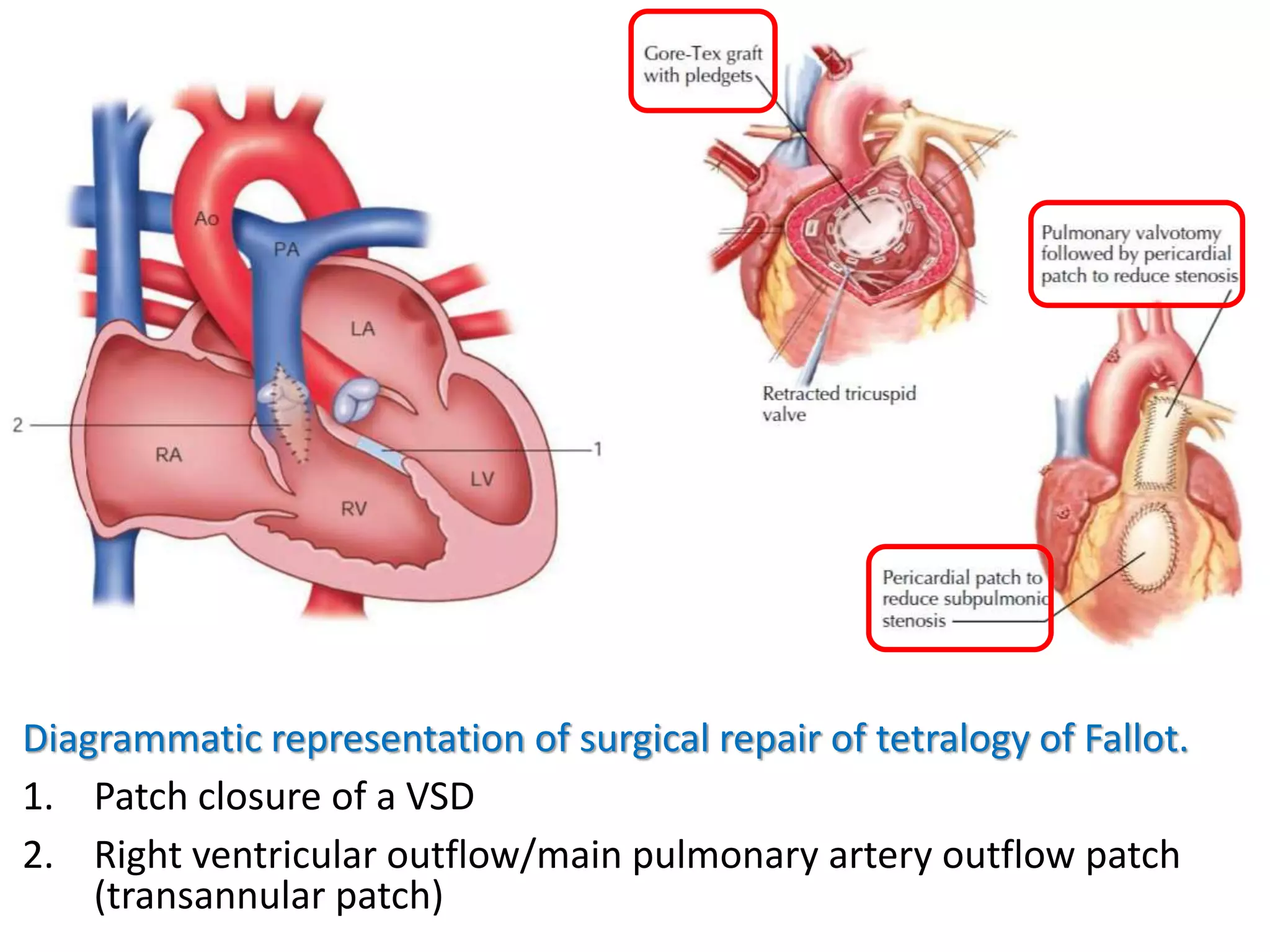 Tetralogy of Fallot (TOF) | PPTX