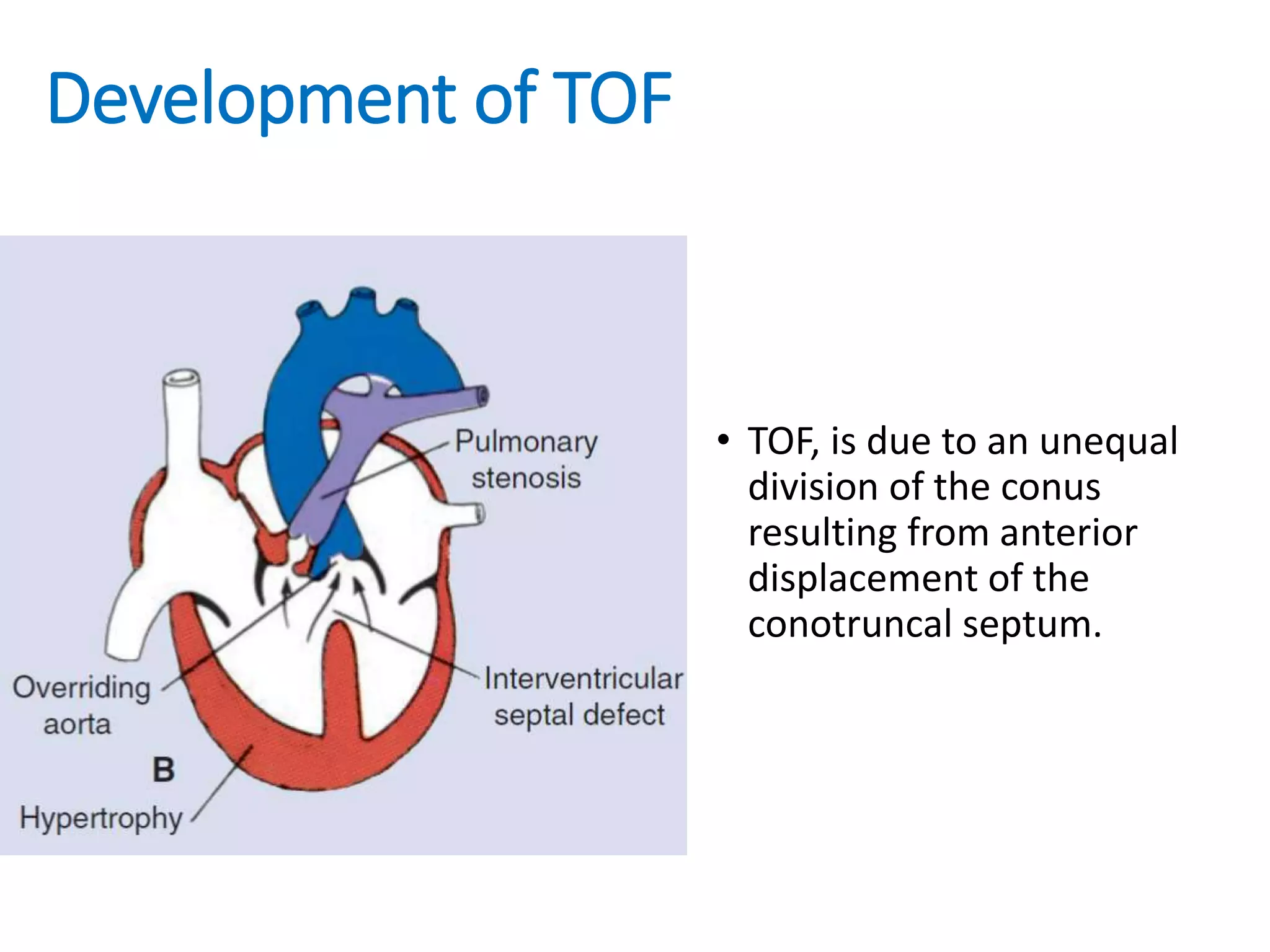 Tetralogy of Fallot (TOF) | PPTX